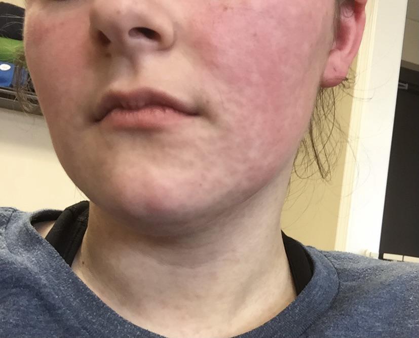 Amoxicillin Rash