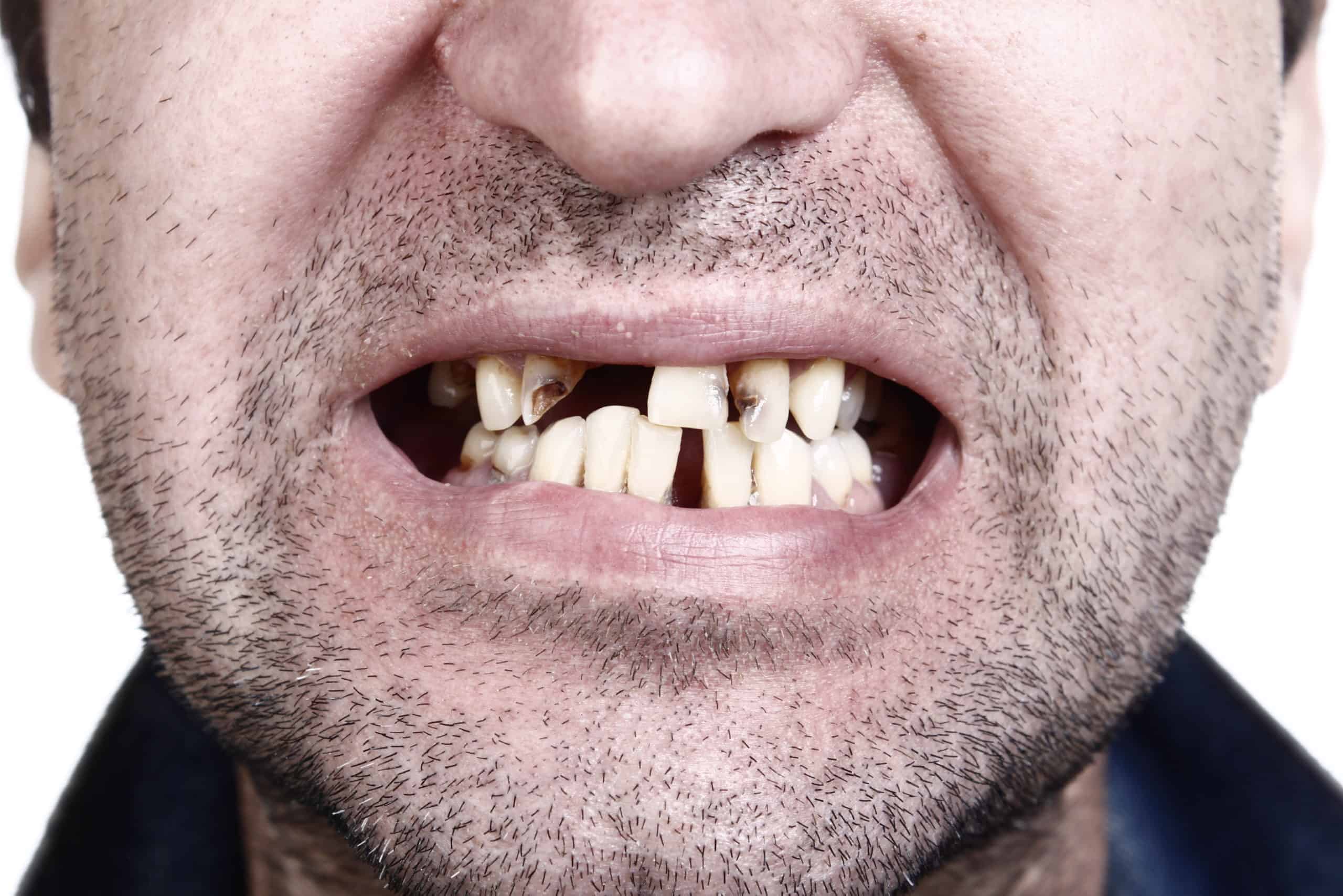 Drug Users Teeth